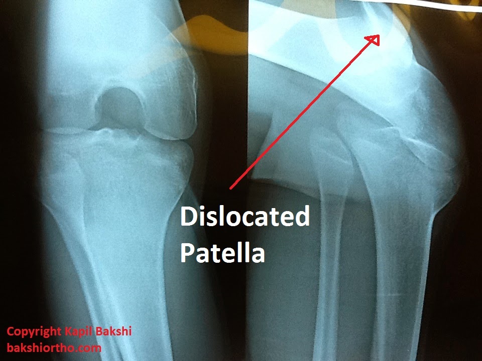 Trauma – Dr. Kapil Bakshi (Bakshi Orthopaedics – A Patient Education ...