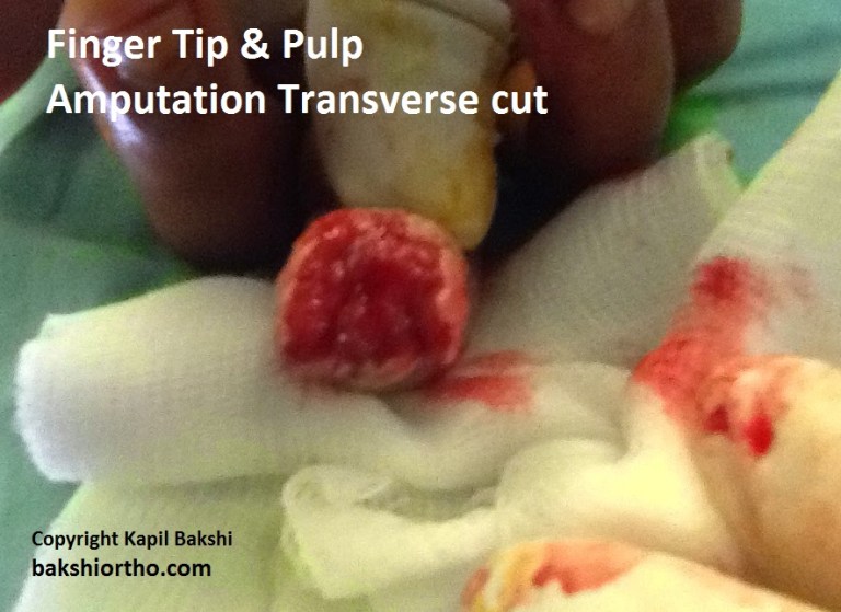 Finger tip and pulp amputation – Dr. Kapil Bakshi (Bakshi Orthopaedics ...