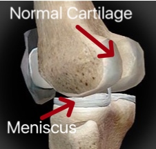 Knee Cartilage Normal – Dr. Kapil Bakshi (Bakshi Orthopaedics – A ...
