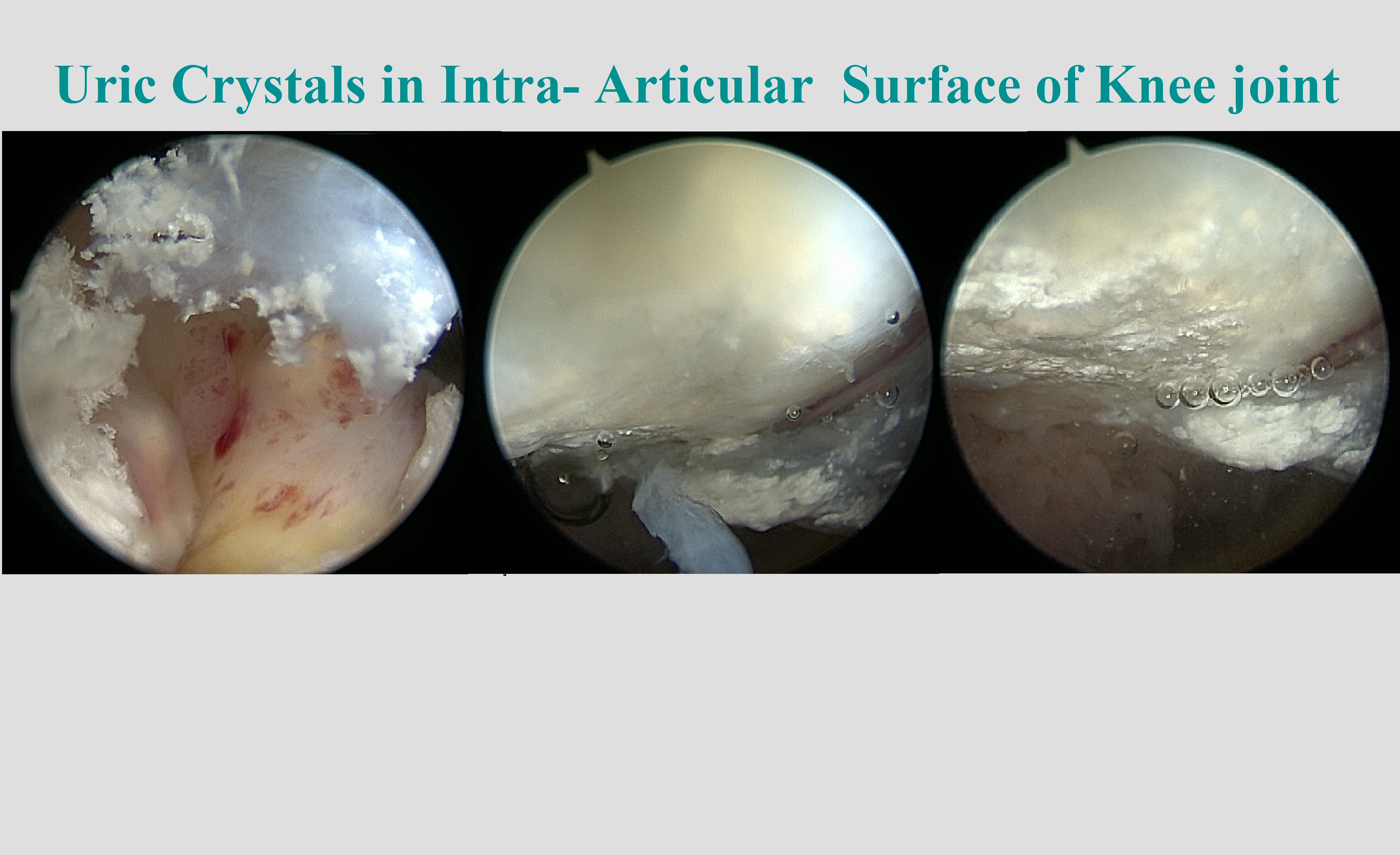 Uric Acid Crystals in Knee Joint – Dr. Kapil Bakshi (Bakshi ...