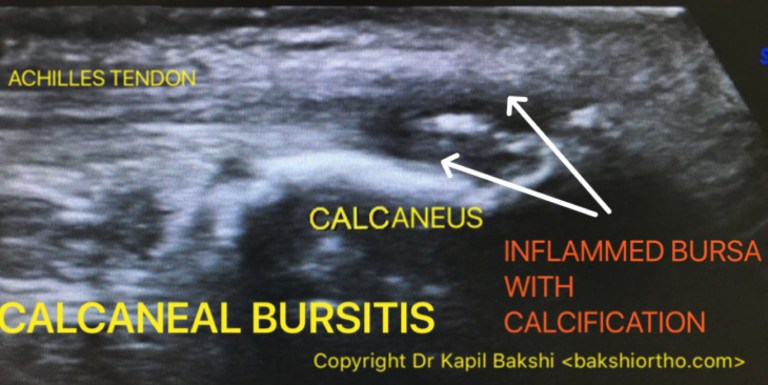 INFLAMMATORY & RHEUMATIC Conditions: Trigger Finger, DeQuervains ...
