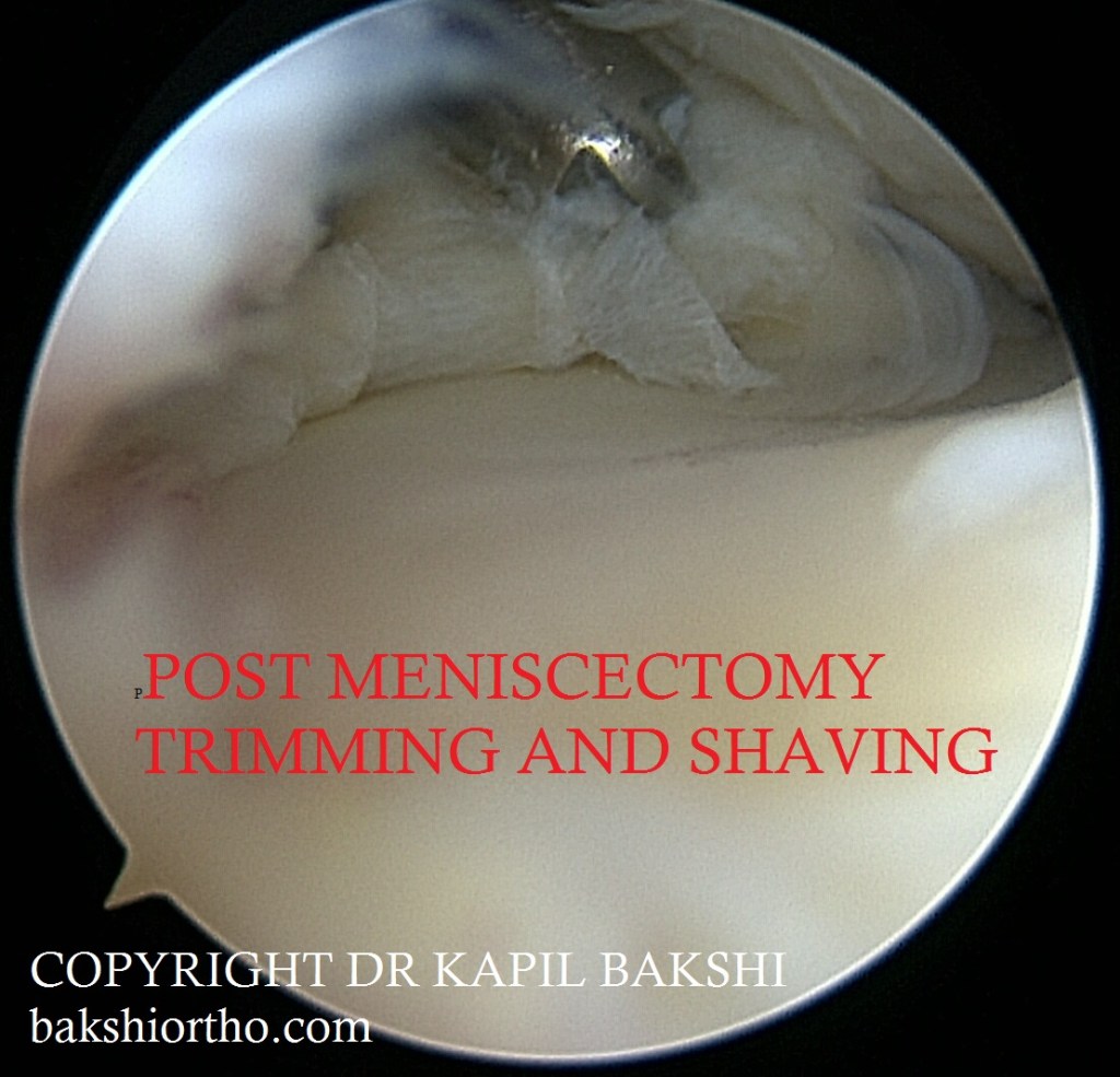 Meniscectomy Trimming and Shaving – Dr. Kapil Bakshi (Bakshi ...