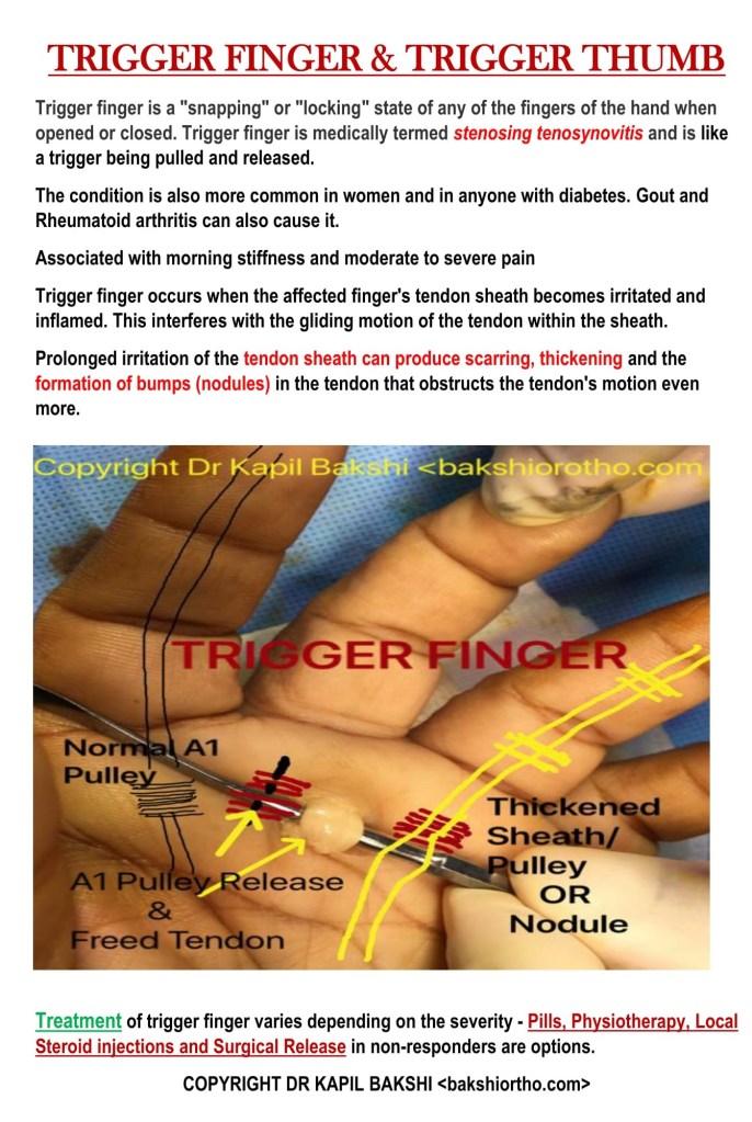 TRIGGER FINGER-1 (1) – Dr. Kapil Bakshi (Bakshi Orthopaedics – A ...