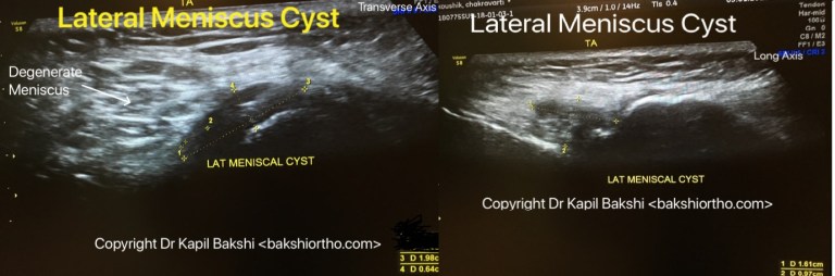 Lateral Meniscus Cyst – Dr. Kapil Bakshi (Bakshi Orthopaedics – A ...