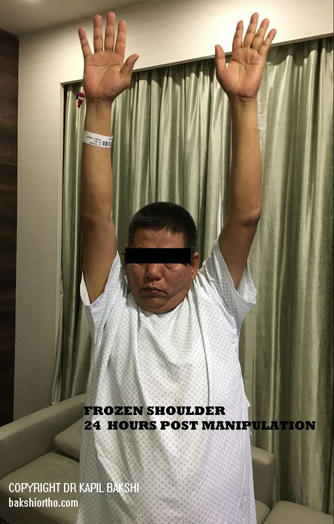 Frozen Shoulder – Adhesive Capsulitis – Rotator Cuff Tendinitis – Dr ...