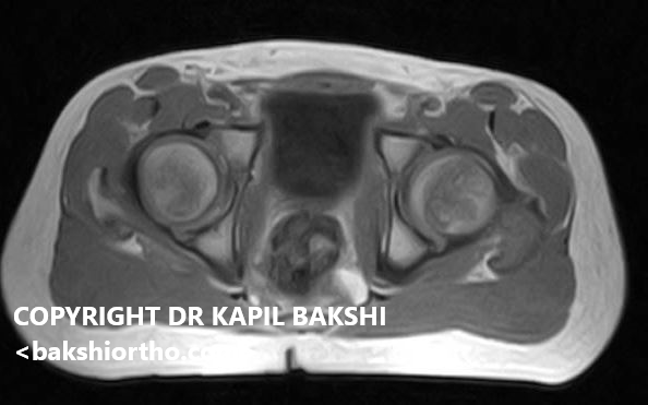 PERTHE’S DISEASE (Leg-Calve-Perthe’s Disease LCPD) – Dr. Kapil Bakshi ...