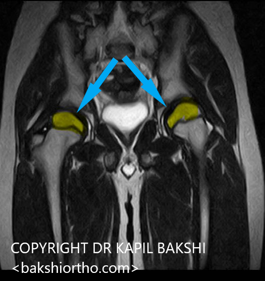 PERTHE’S DISEASE (Leg-Calve-Perthe’s Disease LCPD) – Dr. Kapil Bakshi ...