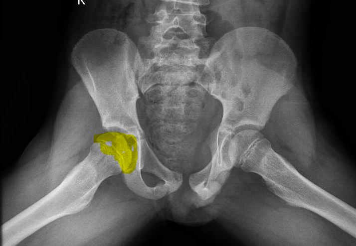 PERTHE’S DISEASE (Leg-Calve-Perthe’s Disease LCPD) – Dr. Kapil Bakshi ...