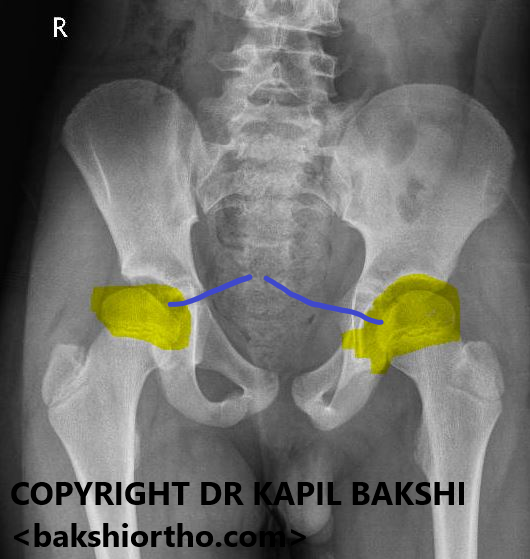 PERTHE’S DISEASE (Leg-Calve-Perthe’s Disease LCPD) – Dr. Kapil Bakshi ...