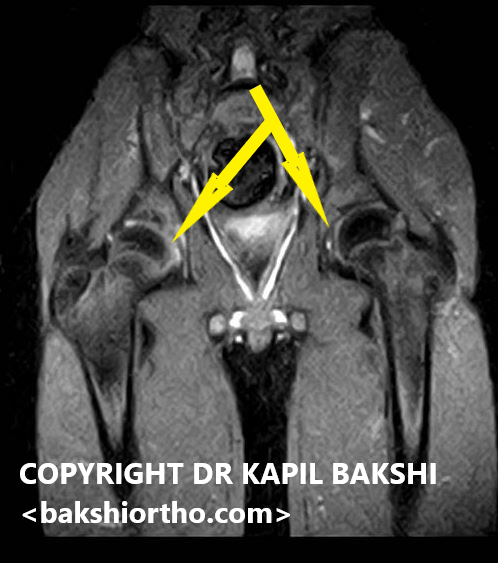 PERTHE’S DISEASE (Leg-Calve-Perthe’s Disease LCPD) – Dr. Kapil Bakshi ...